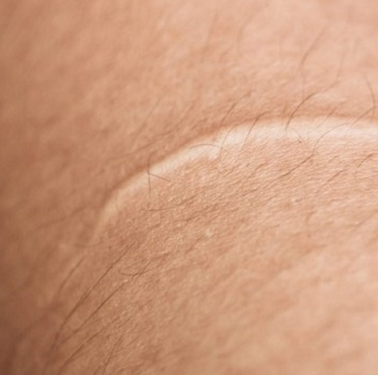 Você Sabe Como a Cicatriz Se Forma e Como Tratar? - Derma Line