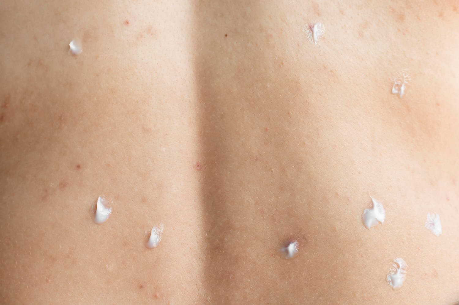 Acne Corporal – Causas e Tratamentos - Derma Line