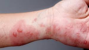 Estrófulo: causas, sintomas, diagnóstico e tratamento - Derma Line
